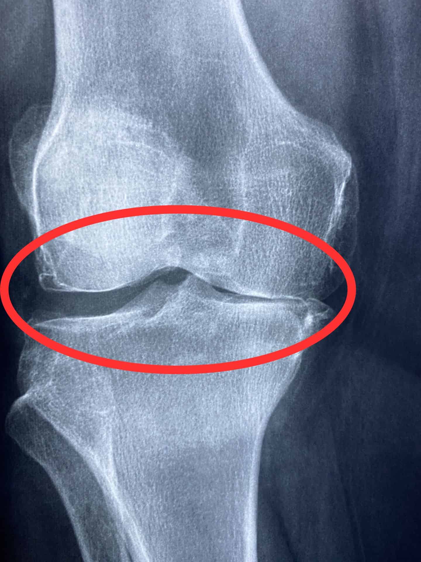 Arthrite ou arthrose? Comment s'y retrouver.